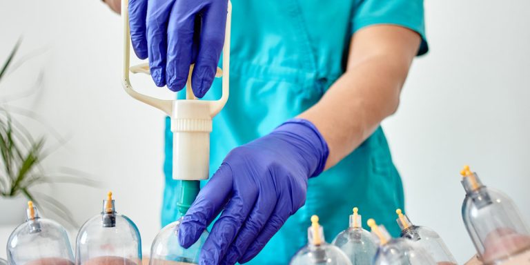 Cupping Therapy – Birmingham-Physiocare